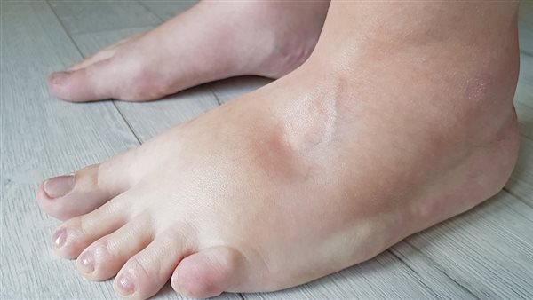 أسباب احتباس السوائل فى الجسم وطرق العلاج